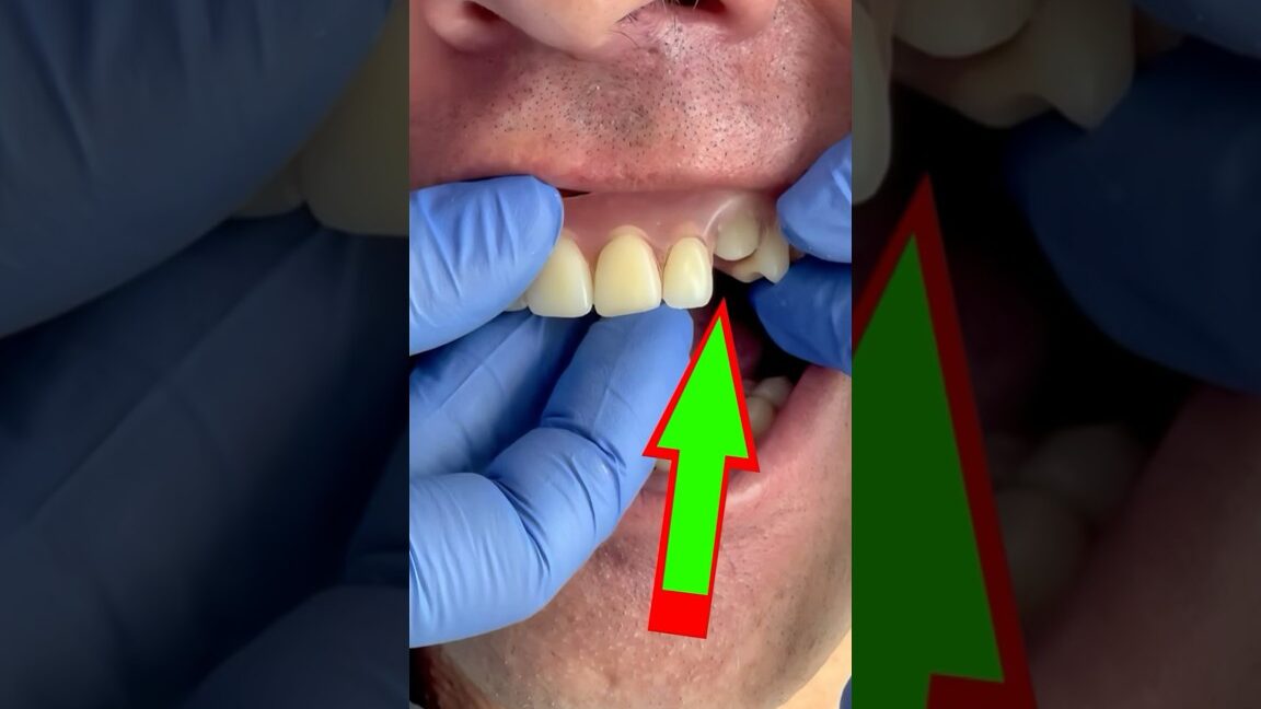 Motstand eller støtte for bruk av proteser for estetiske formål?